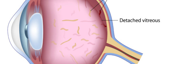 What is a Vitreous Detachment and How is it Treated | FLRI