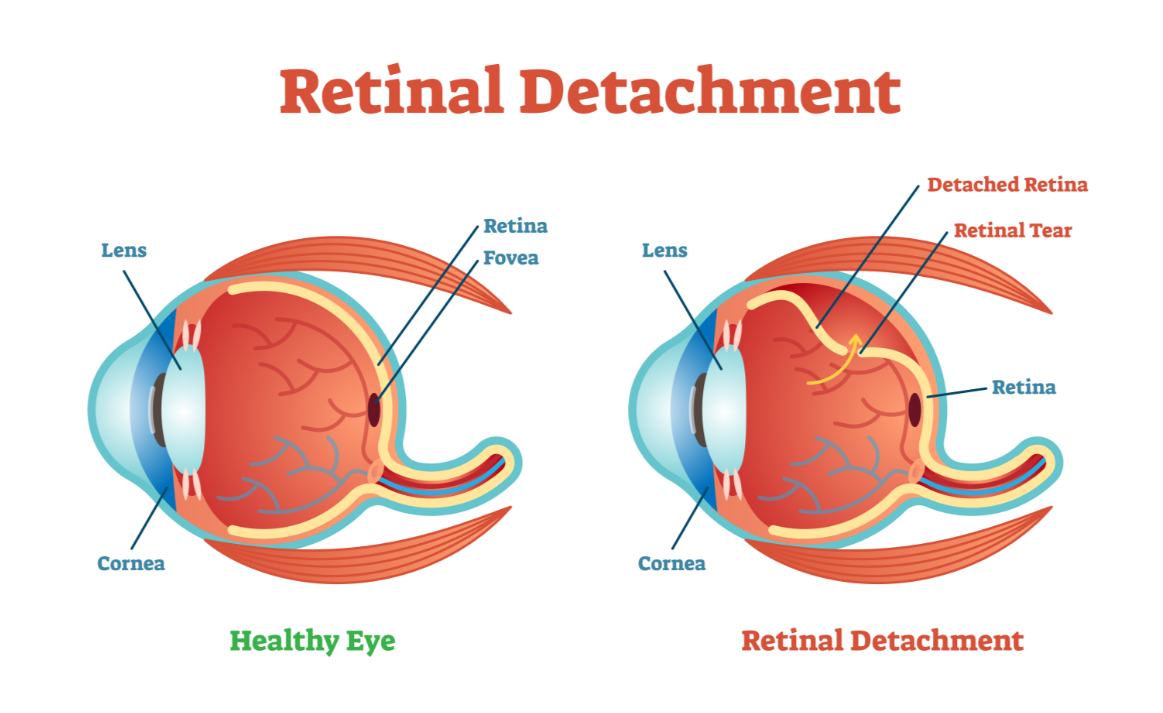 Retinal tear vs retinal detachment – Fort Lauderdale Retina Institute